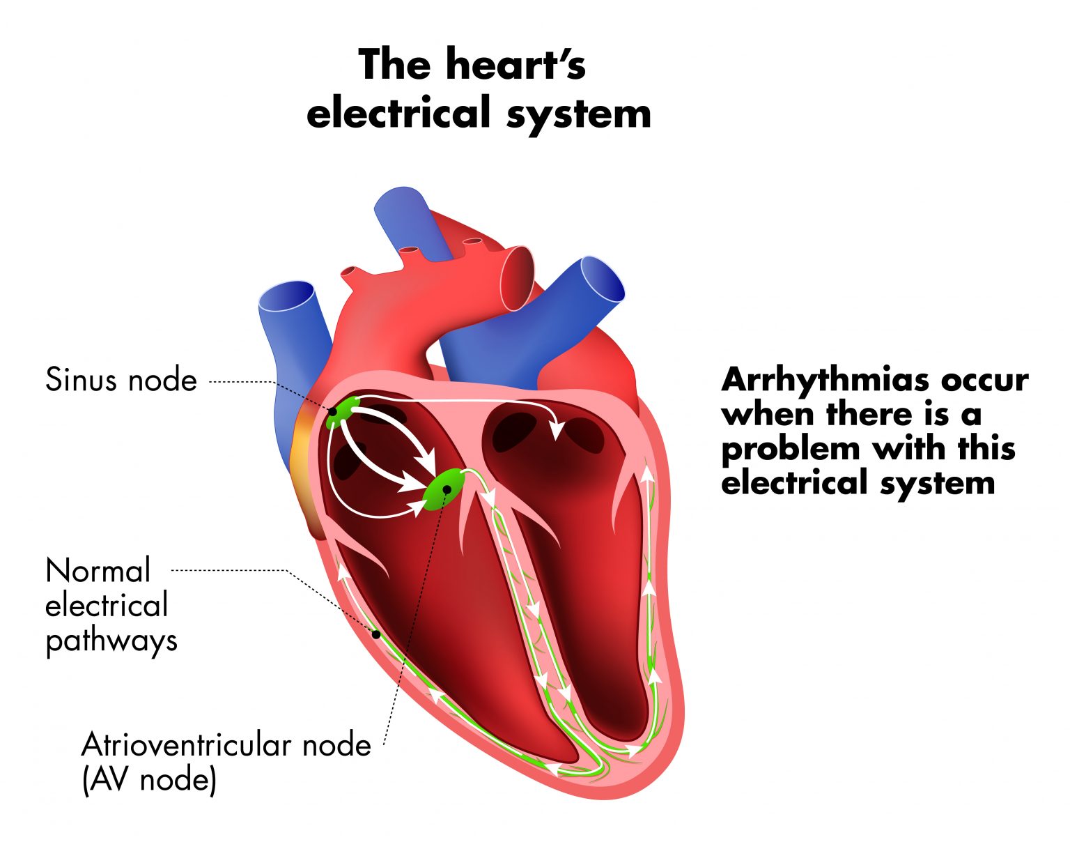 Heart Arrhythmias – Hearts4heart