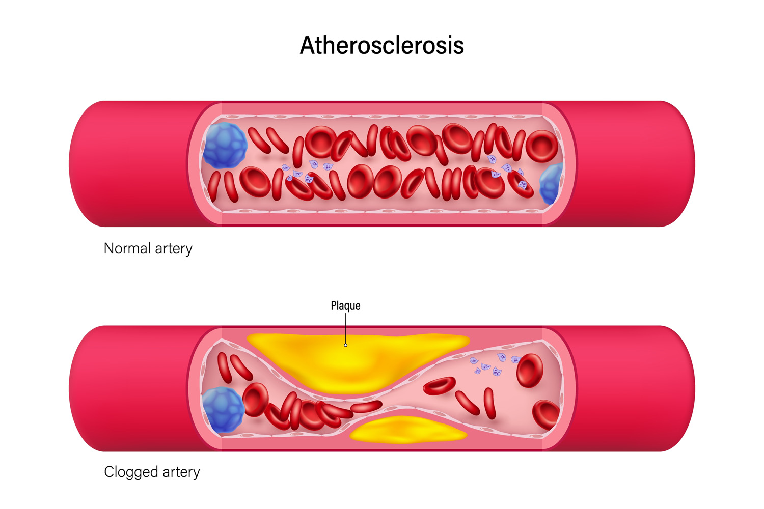 ATHEROSCLEROTIC CARDIOVASCULAR DISEASE - Hearts 4 Heart